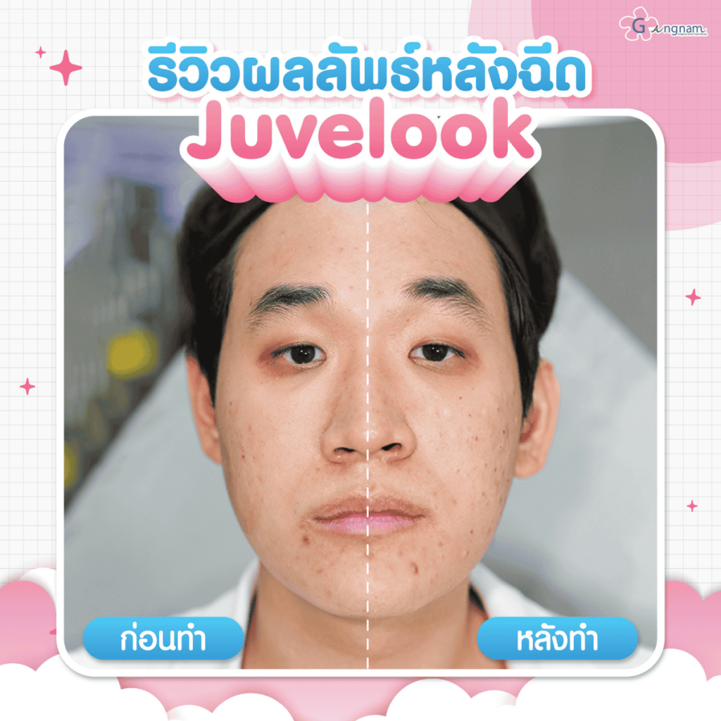 Juvelook คืออะไร? เหมาะกับใคร ต้องฉีดกี่ครั้ง? ช่วยเรื่องอะไรได้บ้าง ...
