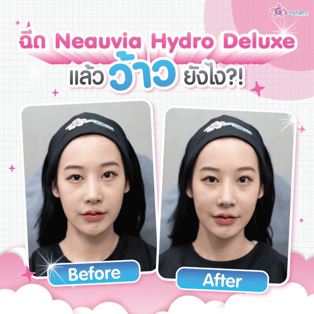 Hydro Deluxe คืออะไร? ช่วยเรื่องอะไรบ้าง? เหมาะหรือไม่เหมาะกับใครบ้าง ...