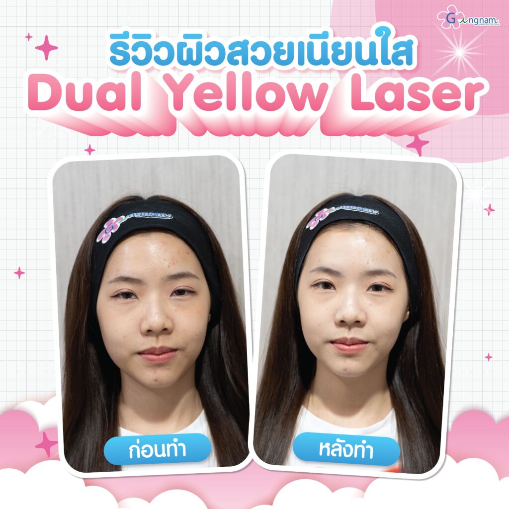 Dual Yellow Laser อันตรายไหม ? ทำที่ไหนดี ? ราคาเท่าไหร่