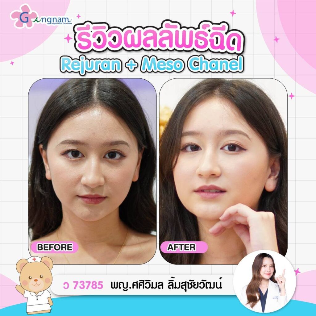 อัปเดตเทรนหน้าใสเกาหลี Rejuran, Meso Chanel, Meso Celine และ Juvelook ...