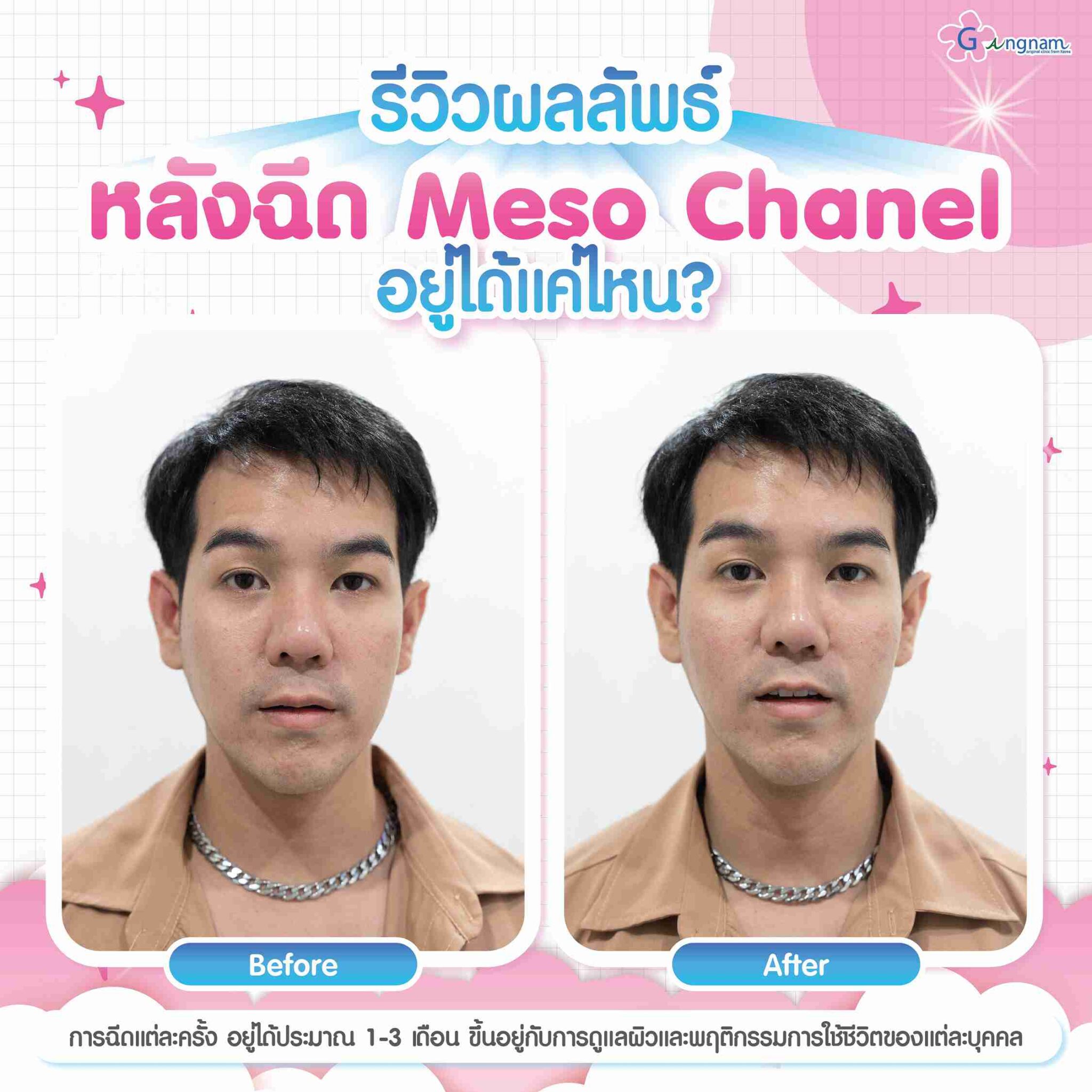 แนะนำ 2025 เมโสชาแนล (Meso Chanel) คืออะไร ? เจ็บไหม